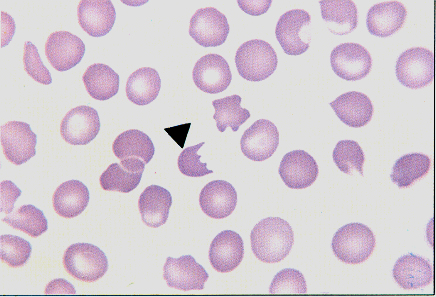 รูปที่ 3-25 Keratocyte (หัวลูกศร) ในสเมียร์เลือดสุนัขที่มีพยาธิหนอนหัวใจ